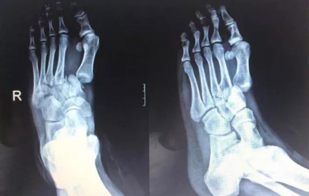 Lisfranc损伤的分型-德医学院-助力医学教育发展！