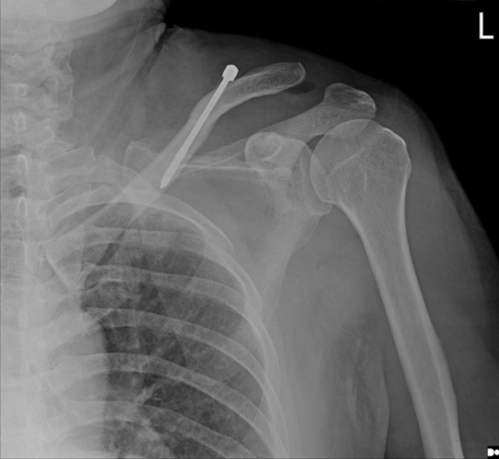 锁骨中段骨折合并肩锁关节损伤的优化治疗:以Knowles钉固定疗效为例-德医学院-助力医学教育发展！