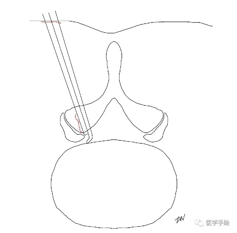 UBE ULBD手术切口位置偏外偏内的差异！-德医学院-助力医学教育发展！