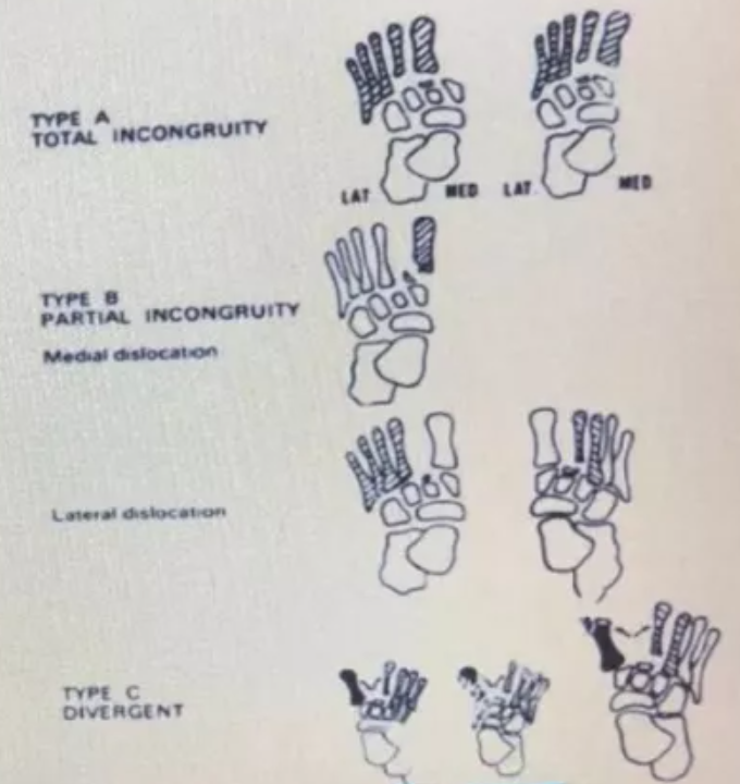 Lisfranc损伤的分型-德医学院-助力医学教育发展！