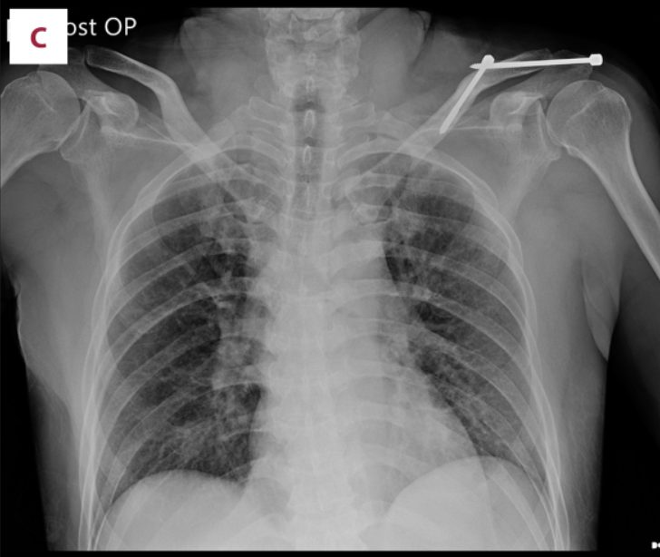 锁骨中段骨折合并肩锁关节损伤的优化治疗:以Knowles钉固定疗效为例-德医学院-助力医学教育发展！