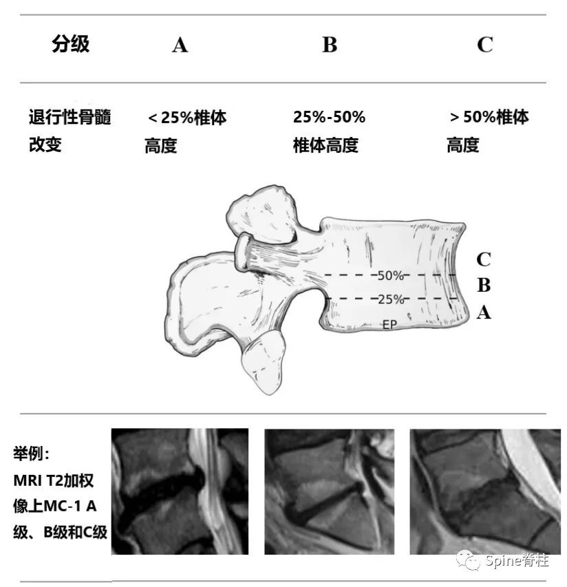 Modic改变的定义和临床分级-德医学院-助力医学教育发展！